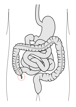 Wurmfortsatz – AnthroWiki